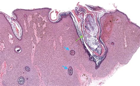 Queratosis Seborreica Costa Rica Síntomas Causas Y Tratamientos