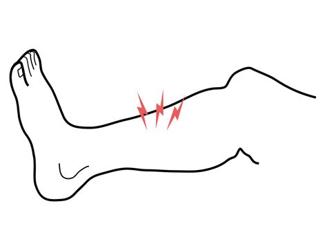 Are Shin Splints Visible On X Ray At Lachlan Legge Blog