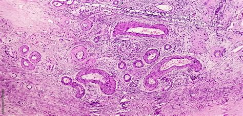 Histology Peritoneal Inclusion Cyst Paraovarian Cysts Hydrosalpinx