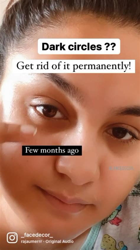 How To Treat Dark Circles Darkcircle Facedecor Artofit
