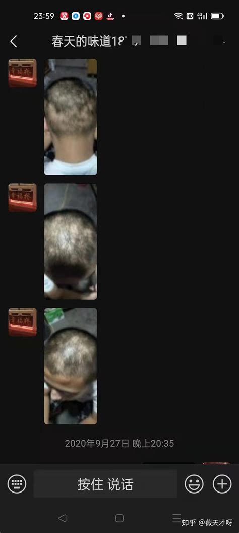斑秃有救了！！！ 知乎