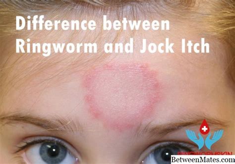 Jock Itch Vs Herpes