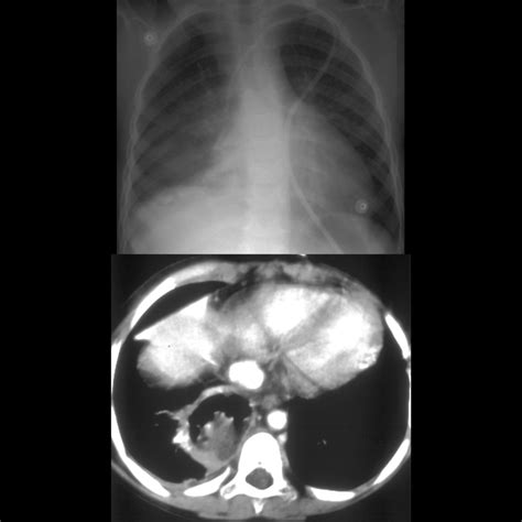 Immune Suppressed School Ager With A Fever Pediatric Radiology Case