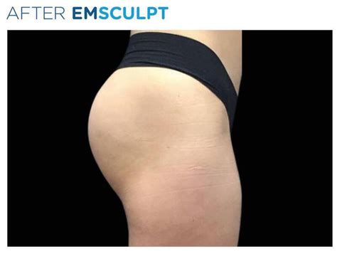 Emsculpt Gluteal Augmentation Gallery Before And After Patient 01 Ocean