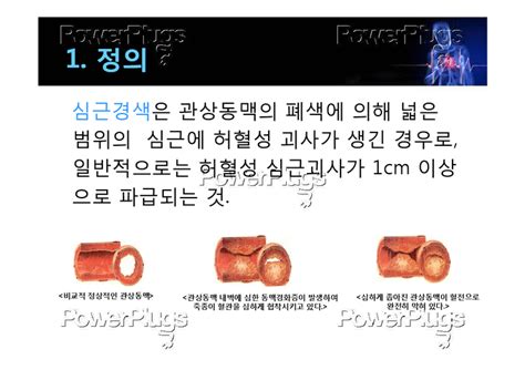 간호학 심근경색의 진단 및 간호과정 의약학