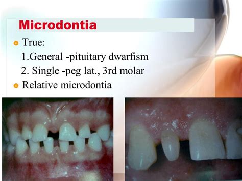 True Generalized Microdontia