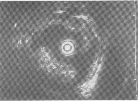 Figure 4 From Successful Endoscopic Resection Of An Early Carcinoma Of The Duodenum Semantic