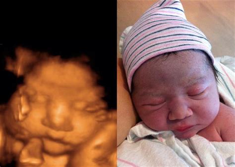 23 Imagens De Bebês Antes E Depois Do Ultrassom 3d