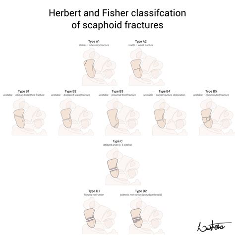 Radiopaedia Case Herbert And Fisher Classification Of Scaphoid