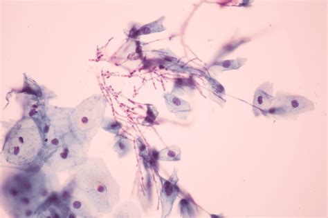Candida Vaginal Infection