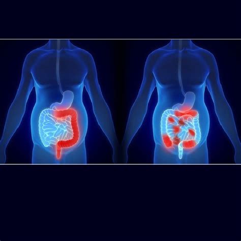 Storosios žarnos Vėžys Ką Reikia žinoti Euromedika