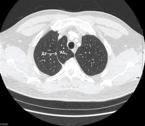 The Azygos Lobe And Vein Interesting And Typical Clinical Image Bmj