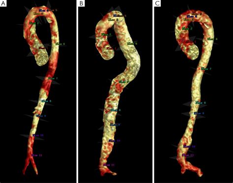 Figure 1 From Assessment Of Aortic Hemodynamics In Patients With