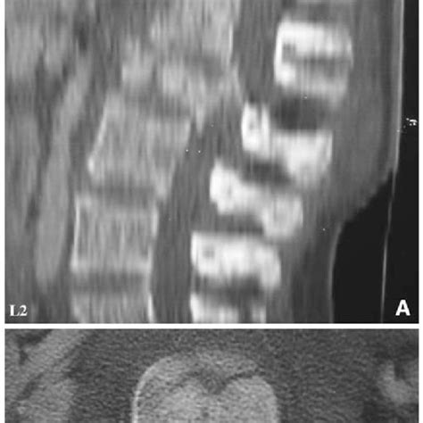 Sagittal Reconstruction And Axial View Of The Ct Scan Showing The Burst