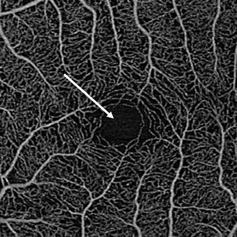 Examples Of The Superficial Retinal Layer Imaged By Oct A White Arrows