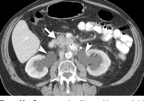 Figure 1 From Retroperitoneal Fibrosis Role Of Imaging In Diagnosis