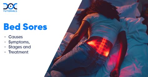 Bed Sores Causes Symptoms Stages And Treatment