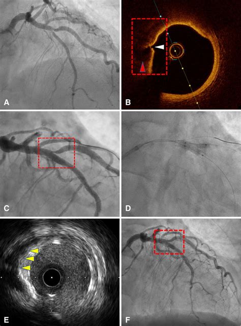 A Ap Cranial View Showing The Stenosis At The Level Of The Lad D2 Download Scientific Diagram