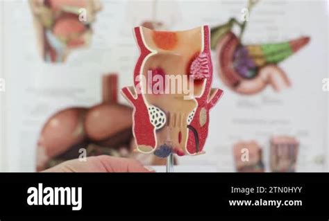 Anatomical Model Of Rectum With Hemorrhoids In Clinic Chronic Hemorrhoids Causes Symptoms And