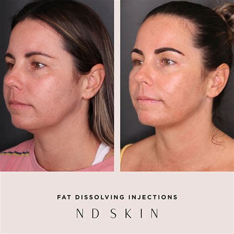 Fat Dissolving Injections Gallery ND Skin Clinic