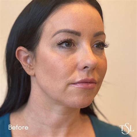 Dermal Fillers Brisbane The Skin Lab