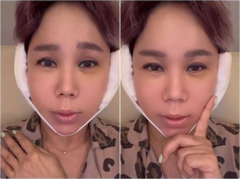 ‘강원래♥ 김송 광대수술→한 달만에 심각한 후유증 “생니를 뽑는 느낌” Oh쎈 이슈