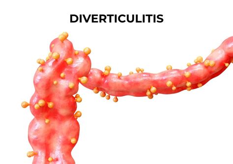Premium Photo Diverticulitis Is A Disease That Occurs When The Diverticula Of The Large