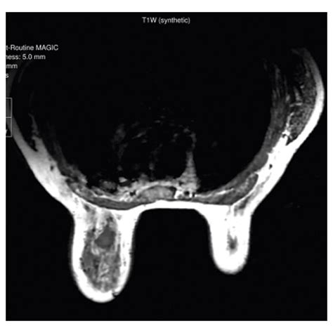 47 Year Old Female With Invasive Ductal Carcinoma Idc Of The Left