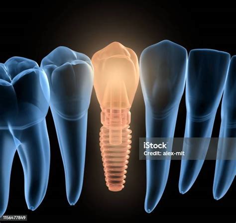 임플란트 엑스레이 보기로 조발치 치아 회복 인간의 치아와 의치 개념의 의학적으로 정확한 3d 그림 건강관리와 의술에 대한 스톡 사진 및 기타 이미지 Istock