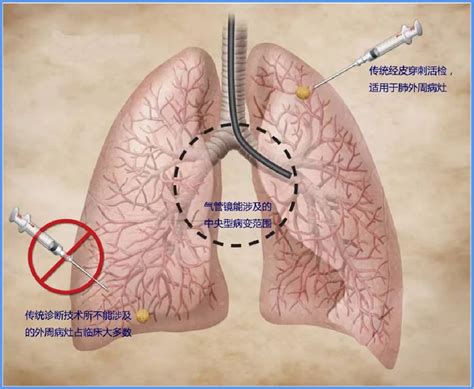 肺结节手术前都要定位么？ 知乎