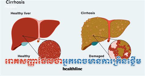 រោគសញ្ញា អ្វីខ្លះ ដែល ថា អ្នក អាច មាន ការ ក្រិន ថ្លើម
