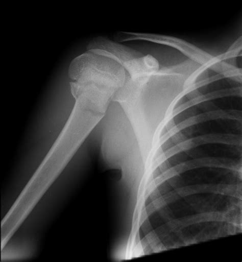 Proximal Humeral Fracture Pacs