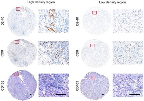A Novel Lymphangiogenesis Related Gene Signature Can Predict Prognosis