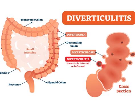 Diverticulitis Dr Neeraj Singh Md Facs Fascrs