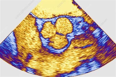 Tricuspid Heart Valve Transthoracic Echocardiography Stock Image