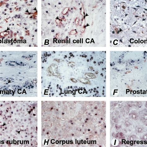 Endothelial Cell Proliferation And Pericyte Recruitment In Individual