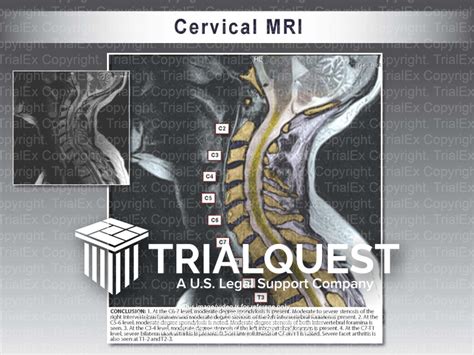 Cervical Mri Trialquest Inc