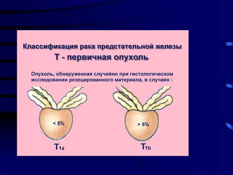 Рак предстательной железы презентация онлайн