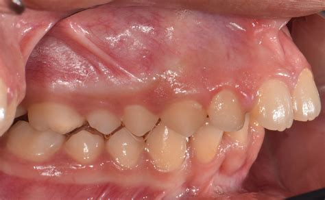 Teeth Protrusion Dr Khaled Alkateb