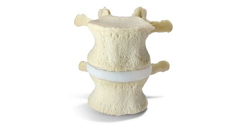 Spondylolisthesis L2 3 Grade 1 Understanding Anterolisthesis In Spine