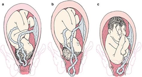 Umbilical Cord Prolapse Causes Of Umbilical Cord Prolapse Hot Sex Picture