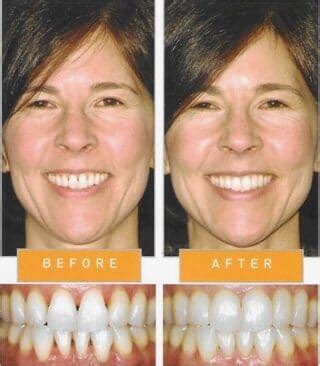 Advances In Cosmetic Dentistry The Bioclear Matrix System Your Health Magazine