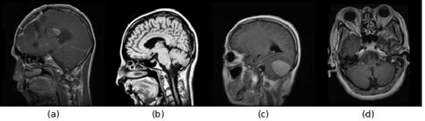 Figure 1 From Automated Multi Class Brain Tumor Classification For Mri