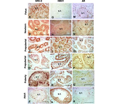 Immunoexpression Of The Coregulators Src 2 And Hbo1 Comparatively To