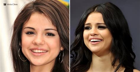 Selena Gomez Teeth Smile Aesthetics Vitrin Clinic