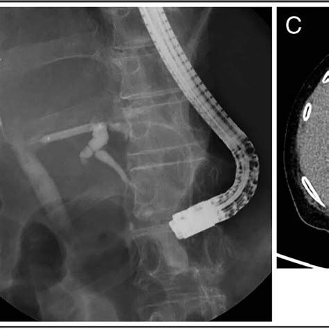On The 64th Day After Cholecystectomy A Dilatation Of The Right