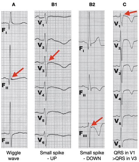 Epsilon Wave LITFL Medical Blog ECG Library Basics