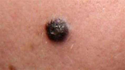Pictures Of Nodular Melanoma