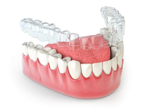 Retainer Kfo Kittsteiner