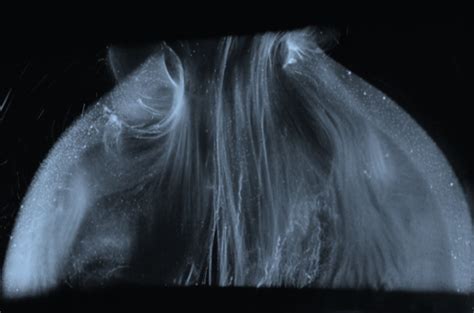 Лечение деструкции стекловидного тела глаза в клинике Доктор Глазов